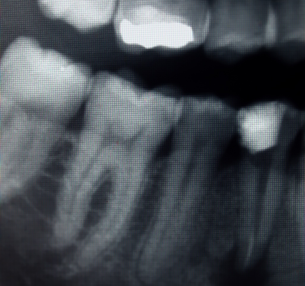 Safely Capturing Clearer Images with Digital X-Rays - Dr. Kenneth J ...